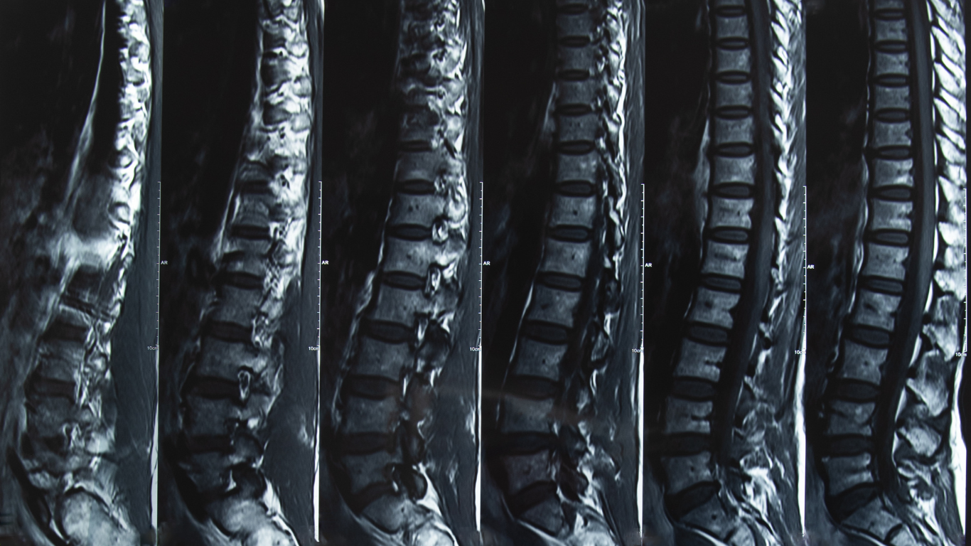 CT Scan for Herniated Disc Diagnosis – Insights from Longevity Health 360