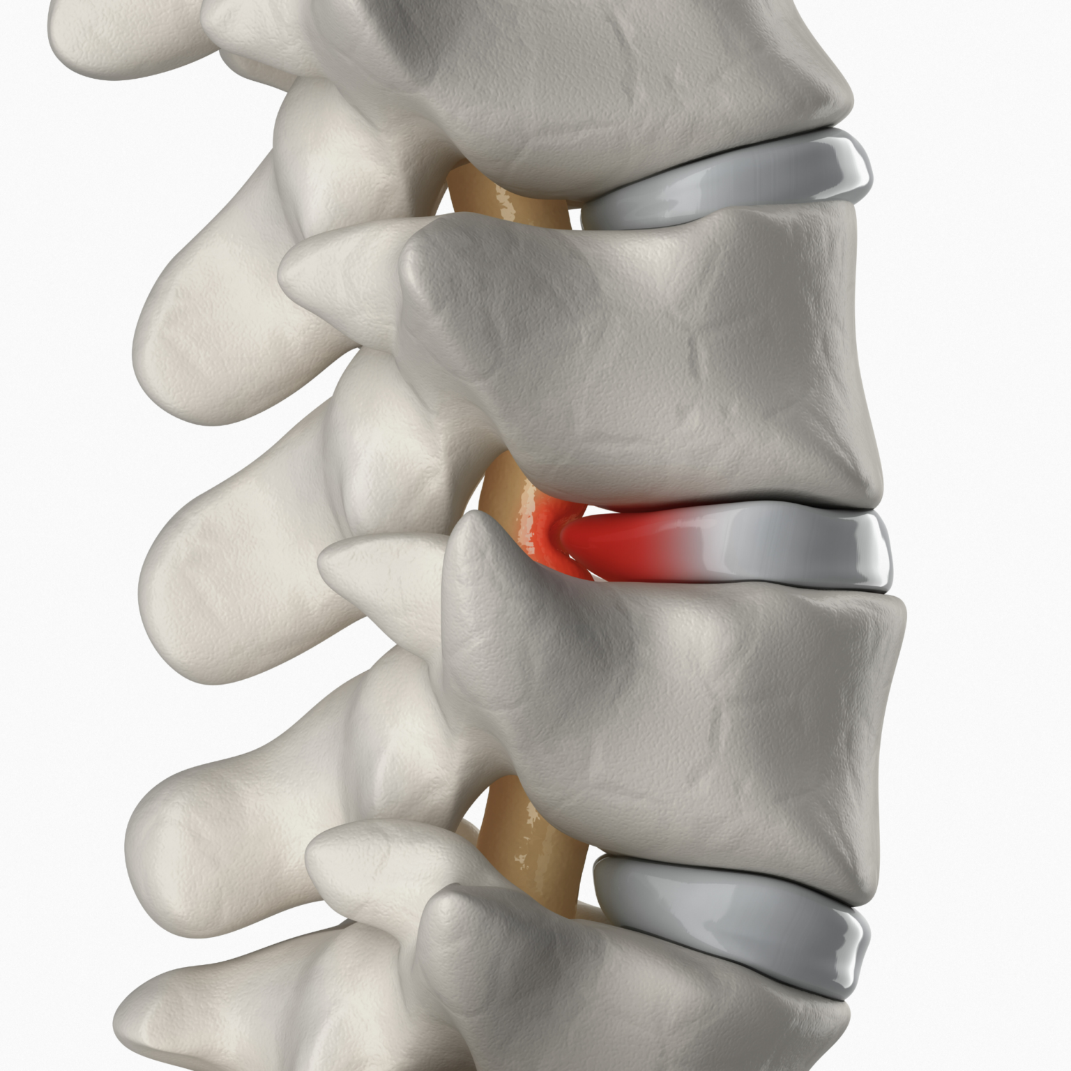 Discseel Procedure for Bulging Discs in Wisconsin | Innovative Relief