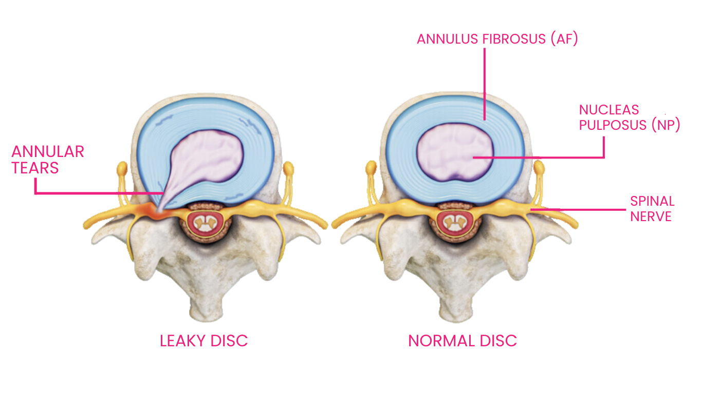 Discseel Procedure in Wisconsin | Top Spine Care